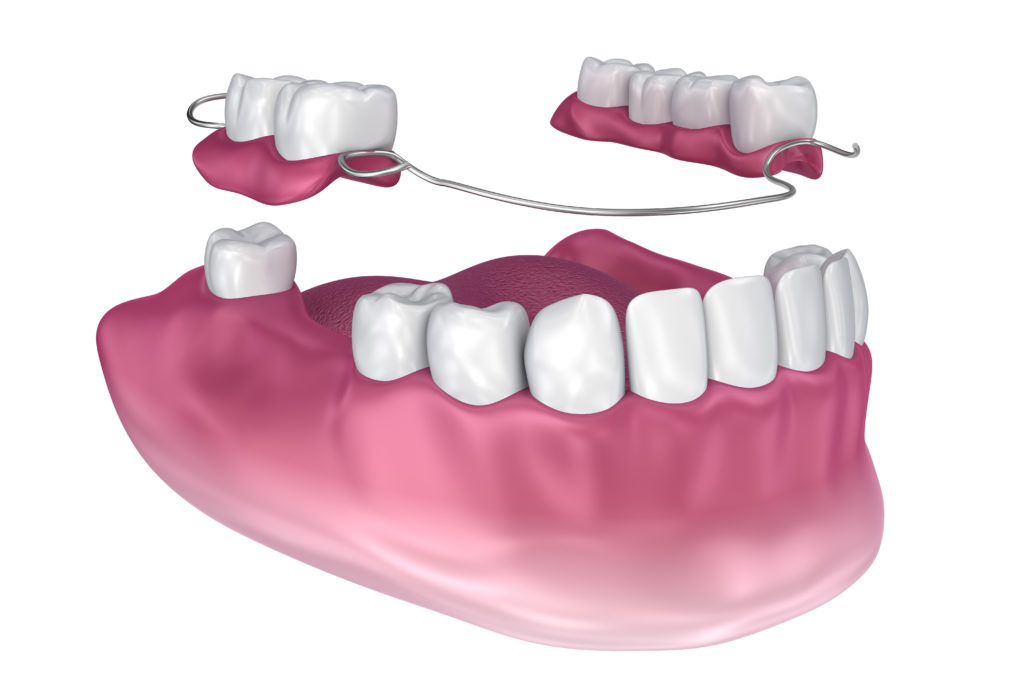 Partial Dentures Vs. Implants Fredericksburg VA | Oral Health